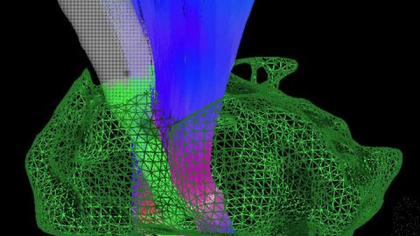 Movement disorders: Rational design of deep brain stimulation with human electrophysiology and ...