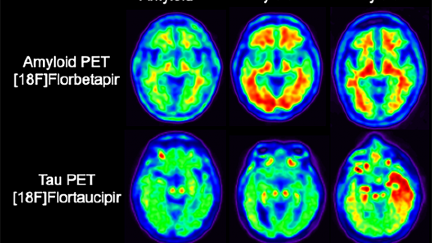 Head-to-head harmonization of tau PET tracers – The HEAD study | Carney ...